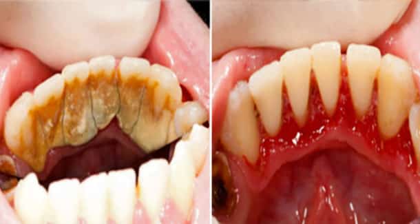 Comment éliminer le tartre présent sur vos dents efficacement