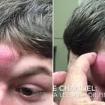 Il se fait percer un énorme kyste sur le front vieux de 6 ans...