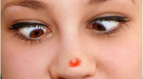 Savez-vous ce que vos boutons révèlent sur votre santé