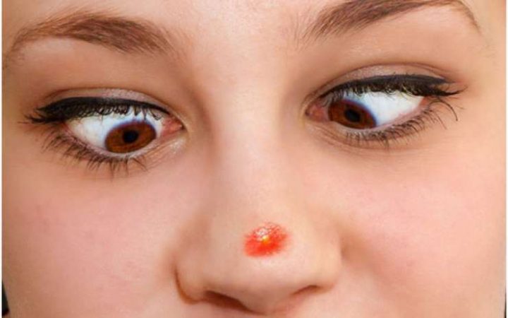 Savez-vous ce que vos boutons révèlent sur votre santé