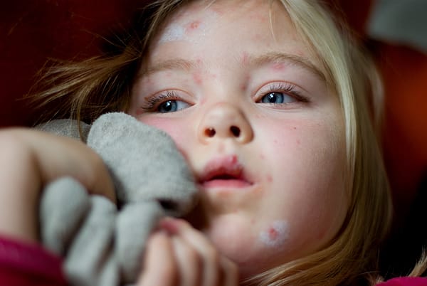 Une épidémie de varicelle ravage la moitié de la France