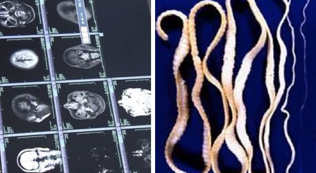 Cet homme s'est retrouvé avec 700 vers dans le cerveau, la poitrine et ...