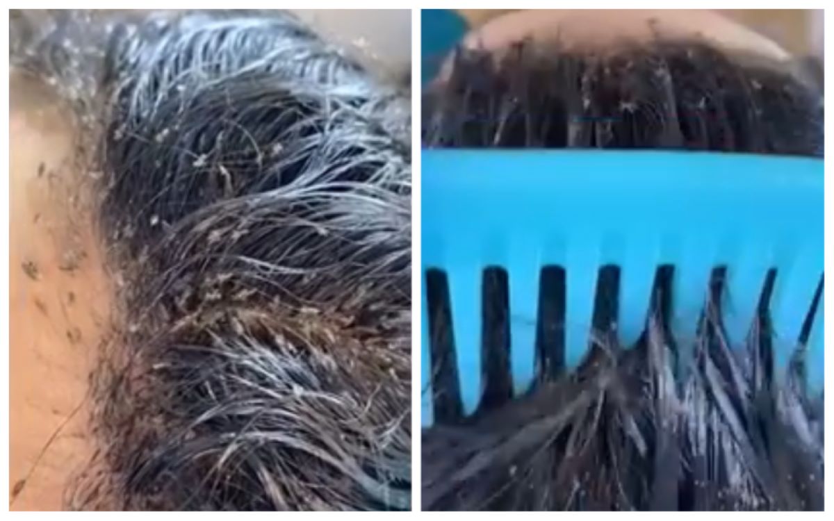 Elle enlève des milliers de poux des cheveux de cette fille (VIDEO)