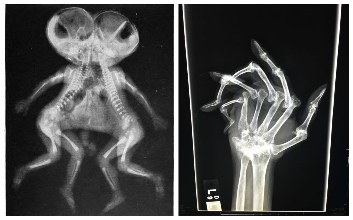 Frère siamois, scoliose, bras en métal : Ces radiographies sous rayon X ...