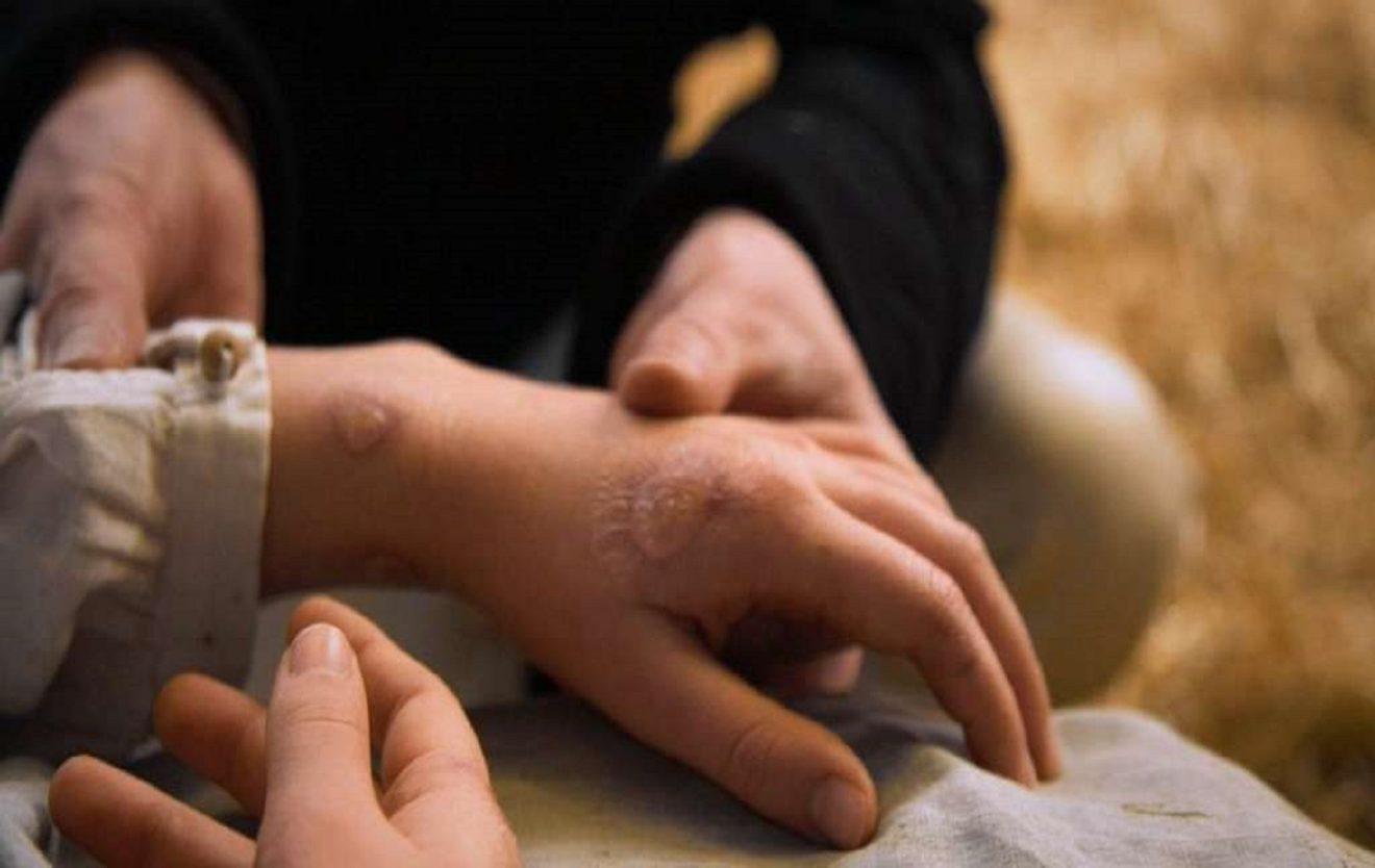 Variole du singe : un premier cas de la maladie recensé en région ...