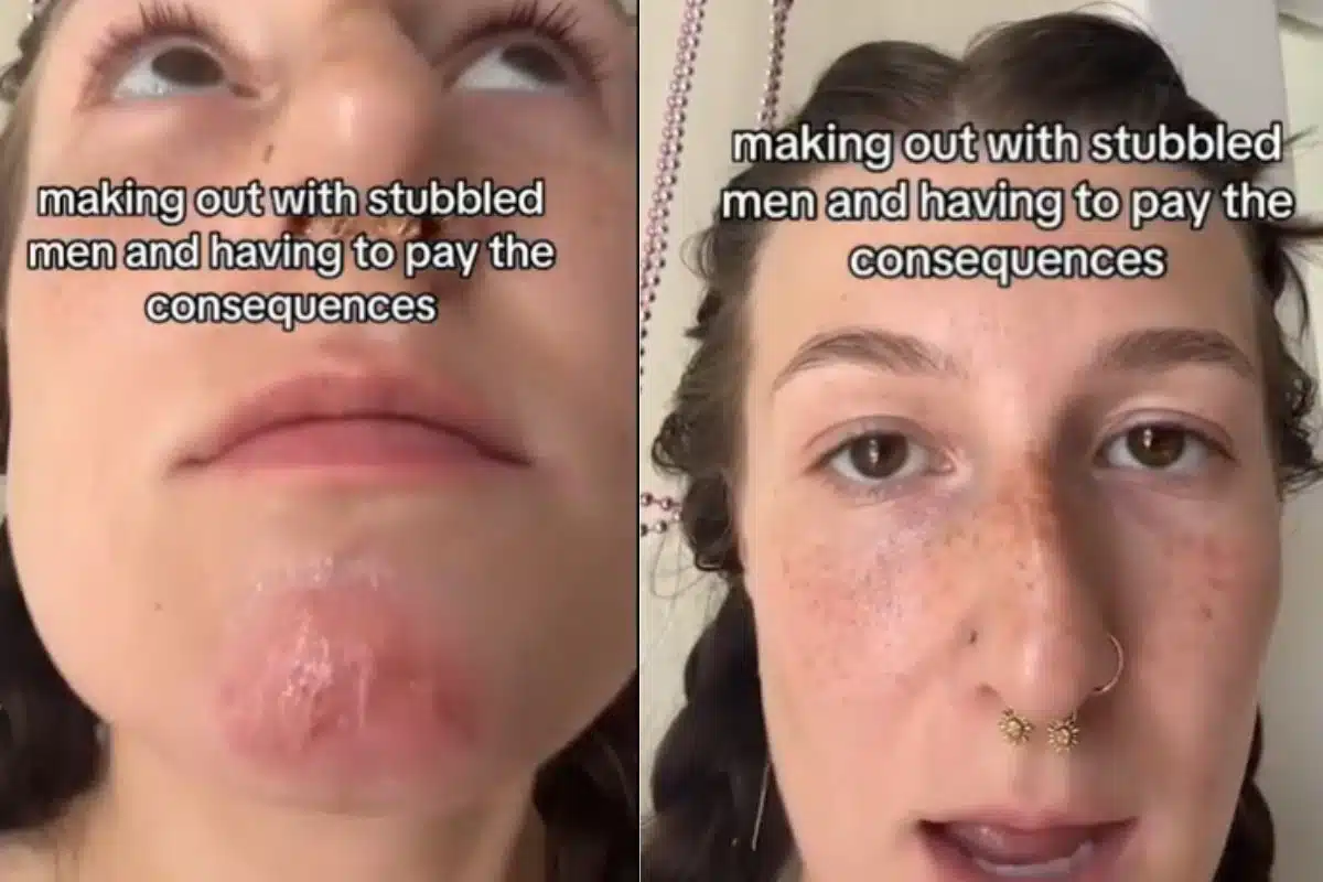 Cette femme montre les conséquences pour son visage d'embrasser des ...