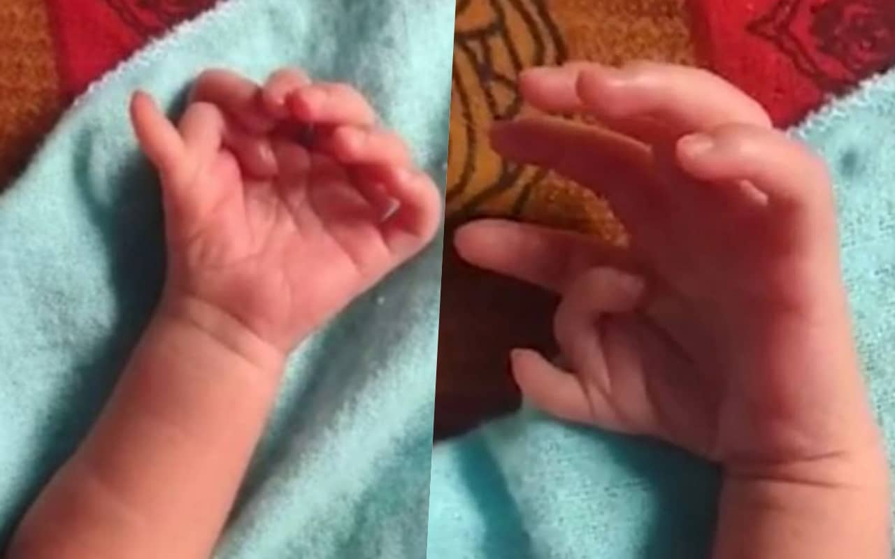 Un bébé naît avec 26 doigts et orteils. Pour ses parents, il est "la ...