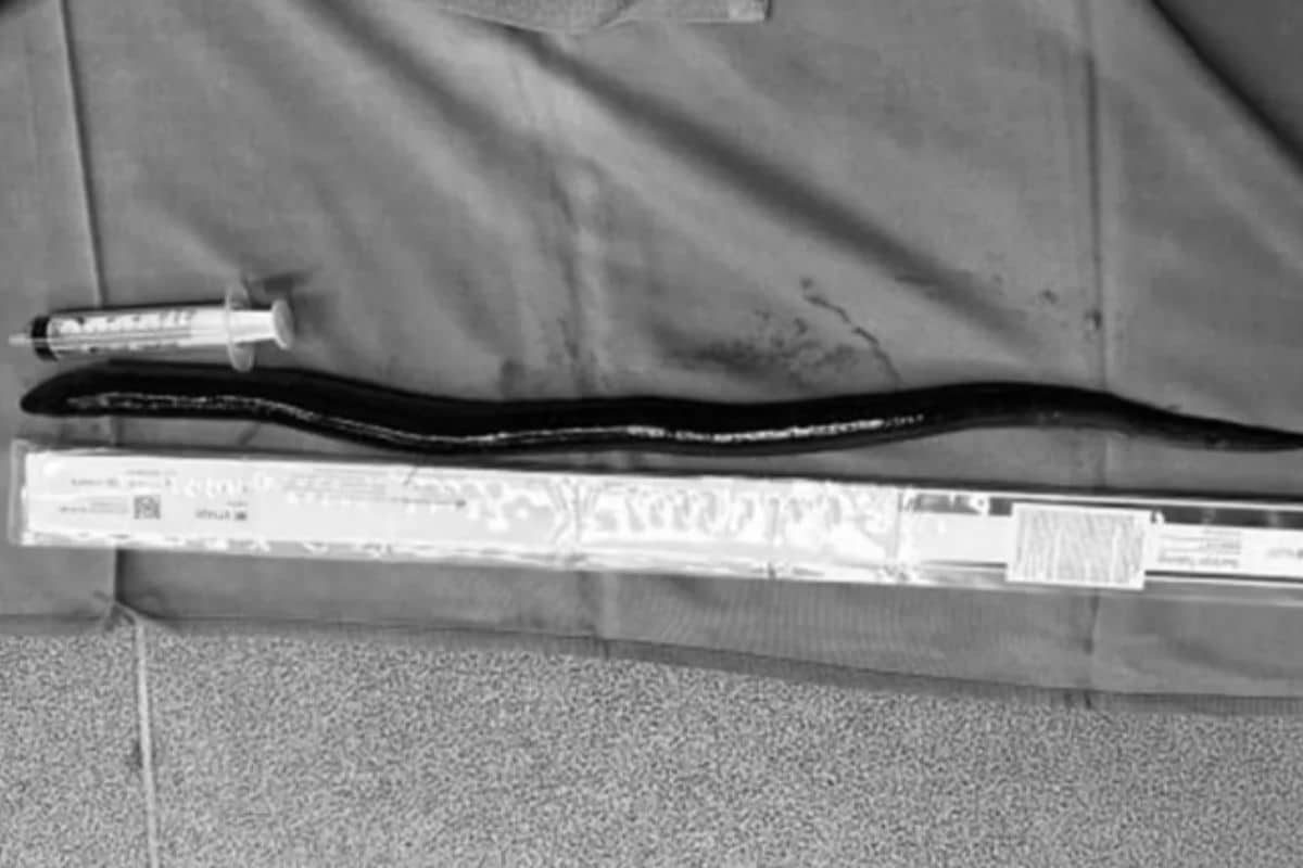 Cet homme avait une anguille vivante de 30 cm dans le corps