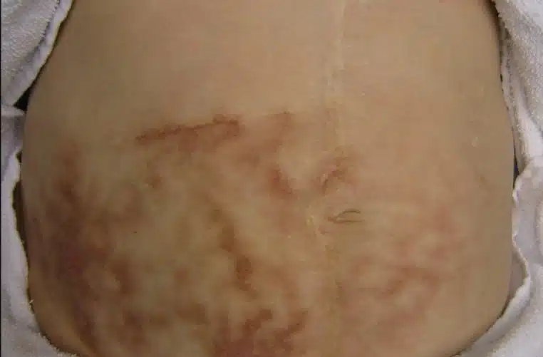 Problèmes de peau en hiver : attention à la dermite des chaufferettes