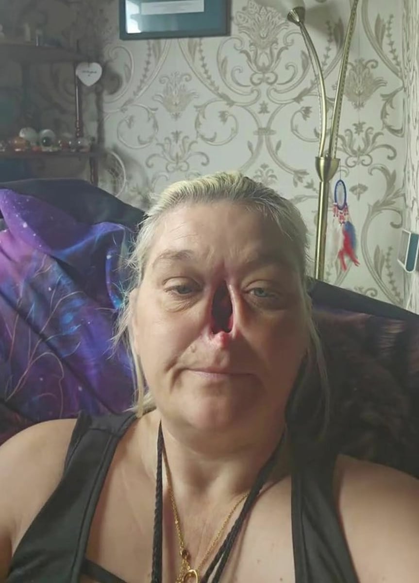 Une femme qui pensait que ses saignements nasaux étaient dus à un ...
