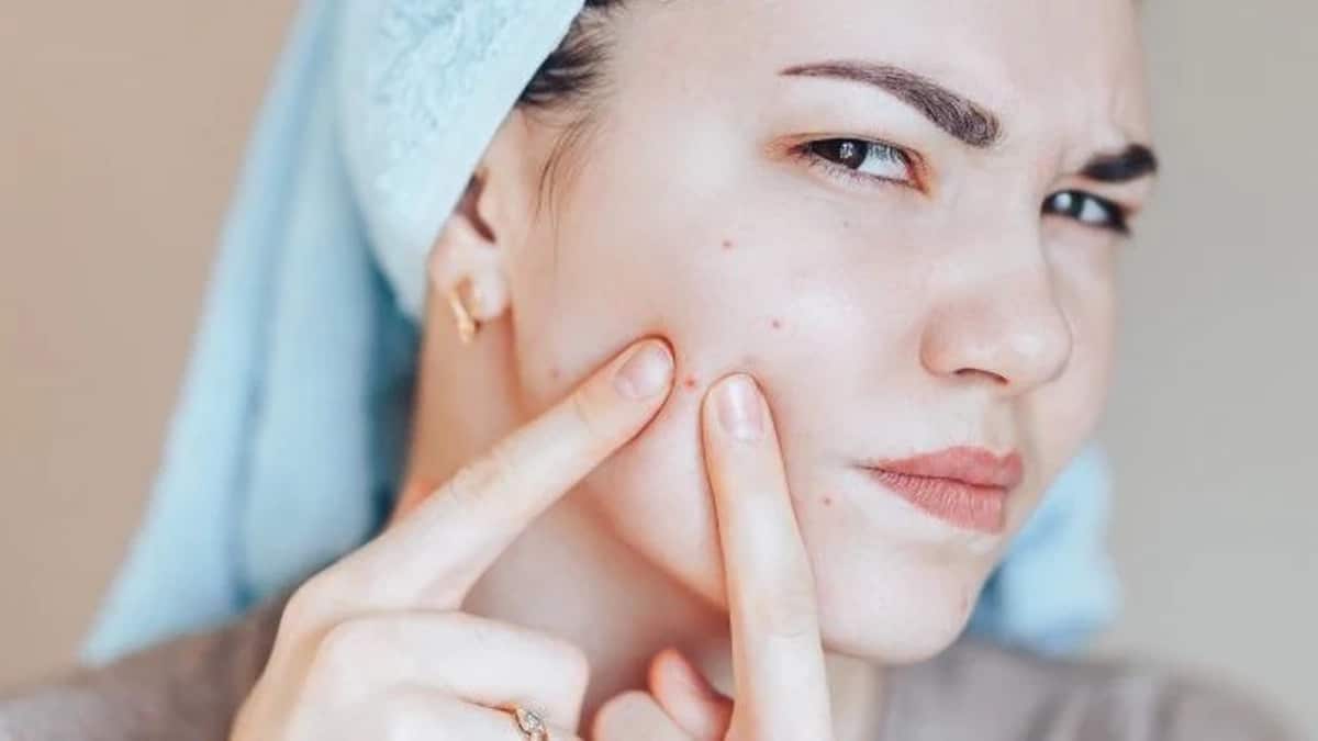 Un dermatologue révèle les boutons sur le visage qu’il ne faut jamais ...